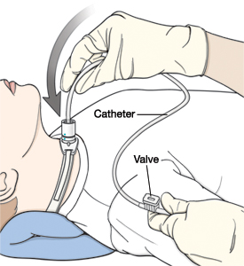 Tracheostomy Suctioning Suction Trach Tracheostomy Tube Inner Cannula