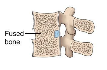 Spinal Fusion: Posterior Lumbar